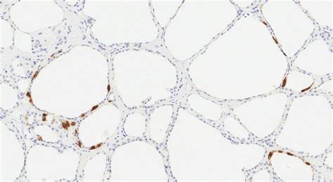 Calcitonin Mypathologyreport