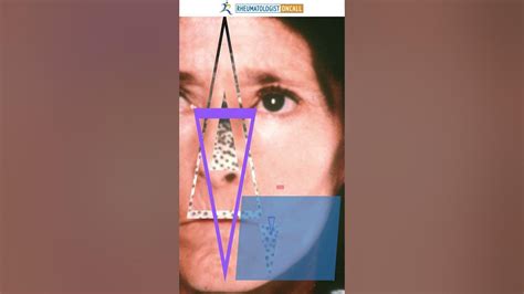 Anti Scl 70 Antibodies Their Role In Diagnosing Scleroderma Youtube