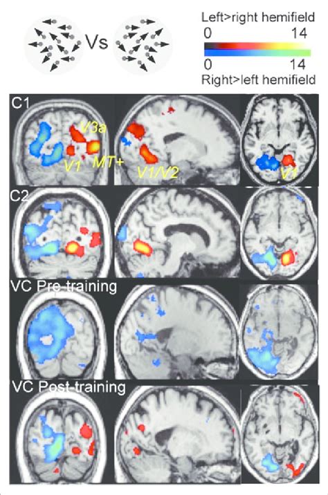 Training Reactivates Early Visual Cortex And Extrastriate Visual Areas Download Scientific