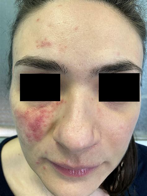 Numerous Isolated Or Grouped Erythematous Papules And Pustules