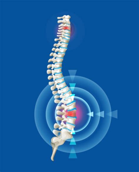 Endoscopic Spine Surgery Endoscopic Spine Surgeon In Ahmedabad