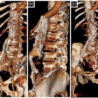 A Pre Operative CT 3D Reconstructions Showing The 18 Mm Gap Between