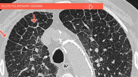 Interlobular Septal Thickening Imaging Atlas