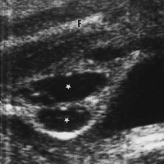 Pdf Prenatal Diagnosis Of An Extensive Fetal Lymphangioma Using