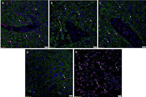 Representative Images Of IF IHC Stained Sections Of GBM Tissue For ESC
