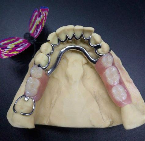 Cast Framework Add Valplast Flexible Dentures Removable Partial Denture