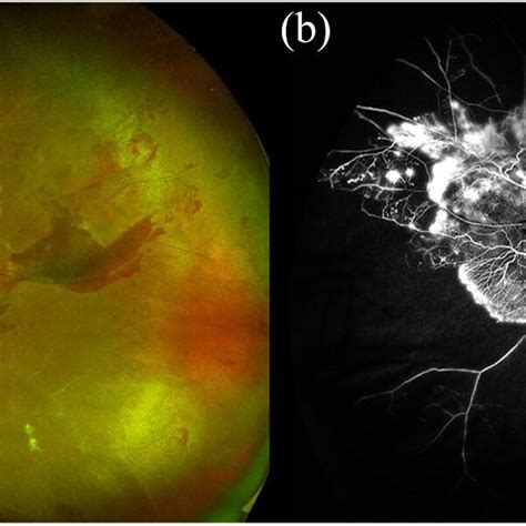 Proliferative Diabetic Retinopathy A Optos Color Fundus Slo Of Left