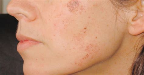 Symptoms Of Primary Biliary Cholangitis