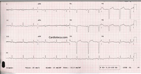 Curso Ecg Cardiopatía Isquémica Crónica Extensa
