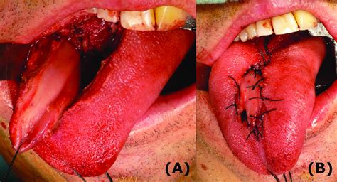 Surgical Pictures From The Partial Glossectomy And The Local Buccinator Download Scientific