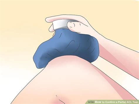 3 Ways To Confirm A Partial Acl Tear