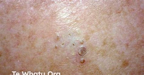 Epidermal Naevus Image