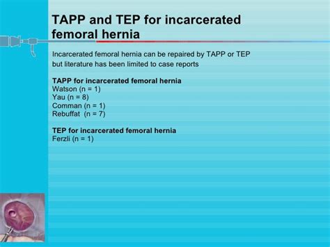 Laparoscopic Inguinal Hernia Repair Where Are We In 2009