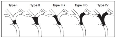 Diagram Of Cholangiocarcinoma Quizlet
