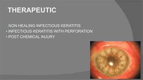 Penetrating Keratoplasty Seminar Pptx