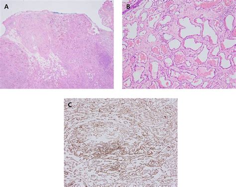 Histopathological Findings Of A Mixed Hemangioma Of The Breast A