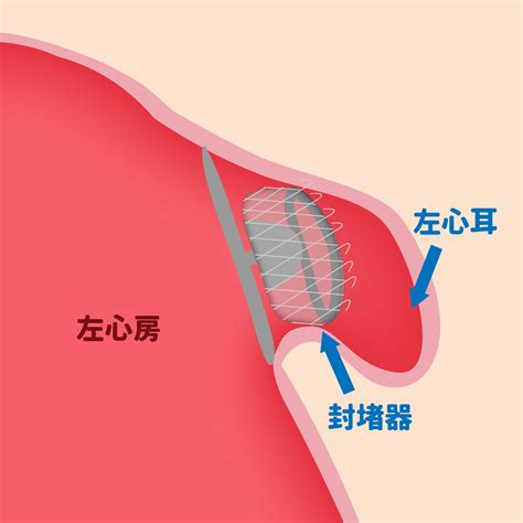 名醫會客室／減少中風與出血的─經皮左心耳封堵術 爽爆新聞網