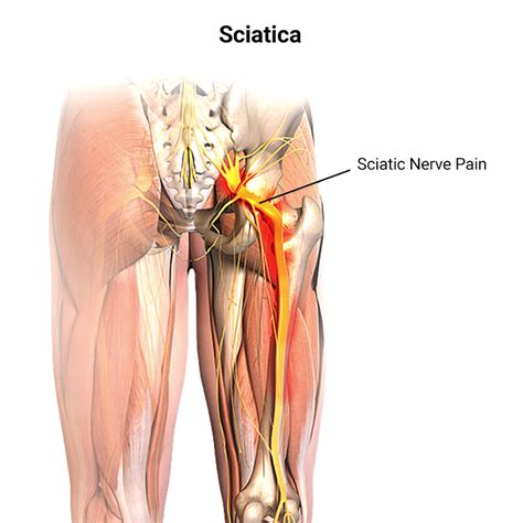 What You Need To Know About Sciatica NJ S Top Orthopedic Spine Pain Management Center