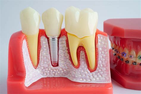 Dental Implant Artificial Tooth Roots Into Jaw Root Canal Of Dental