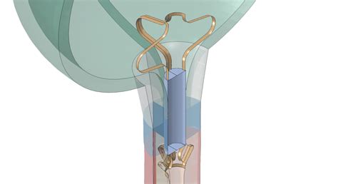 Hpc Simulation For An Endourethral Sphincter Against Urinary Incontinence