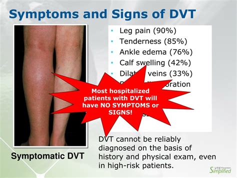 Ppt Vte Prophylaxis Focus On Prevention Powerpoint Presentation Free