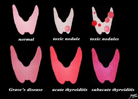 Hyperthyroidism And Thyrotoxicosis The Common Vein