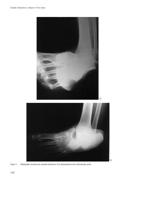 Subtalar Dislocation Pdf