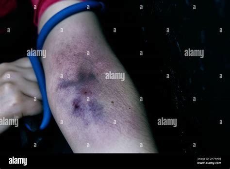 Iv Hematoma