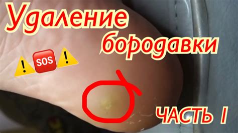 Удаление бородавки ⚠️🆘⚠️ ️ ️ ️ ЧАСТЬ 1 - YouTube