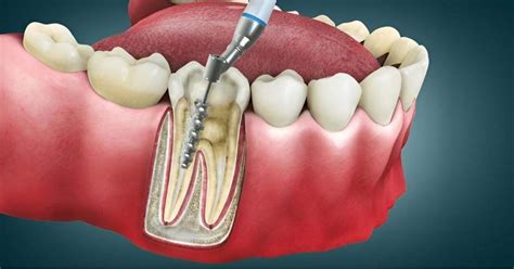 Dentalkart On Linkedin Best Budget Endomotor Under ₹20000