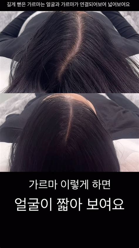 강남두피문신 올디💛 강남smp 탈모 헤어라인 가르마 서울두피문신 강남헤어라인 Smp 두피문신 전문 대표원장 조항은 가르마 길이를 줄여줌으로써 얼굴이 짧아보이는 효과🔥