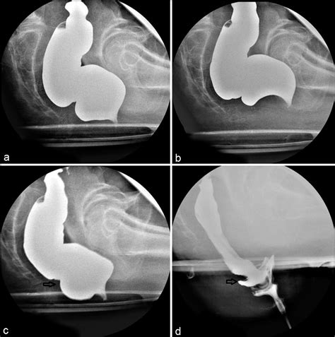 Barium Defecating Proctography And Dynamic Magnetic Resonance