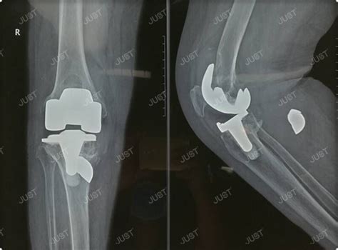 Knee Arthroplasty