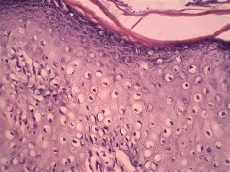 Condiloma Acuminado Verrugas Genitais Verrugas Venéreas