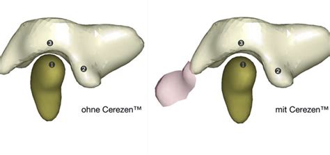 Stereometric Depiction Of The Change In The Condylar Position Using The