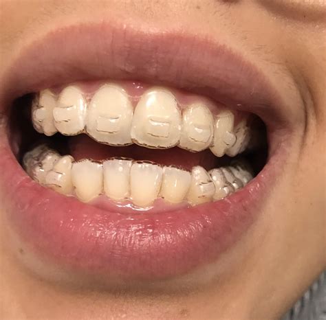 Am I Tracking 🥹 R Invisalign