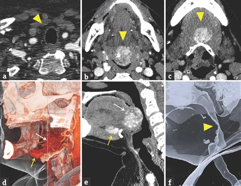 Incidental Finding Of Dual Ectopic Thyroid On Computed Tomography Angiography Journal Of