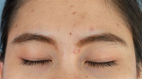 Whats Causing Acne Between Your Eyebrows And How Do You Get Rid Of It