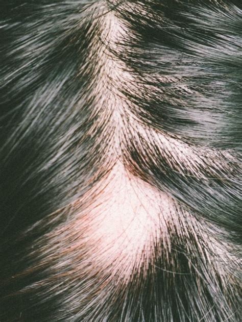 Como é A Queda De Cabelo Por Ansiedade Psicólogos Terapia Online
