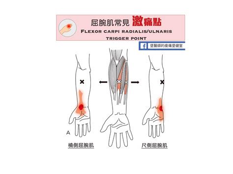 手肘痛、手腕痛、手指痛的原因治療與自我檢查 台北原力復健科診所 侯鐘堡醫師