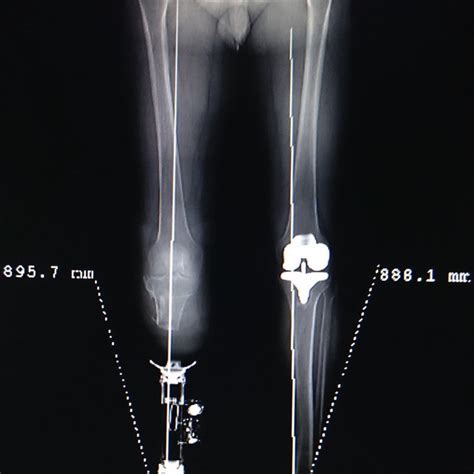 Lateral View With Previous Skin Grafted Site Over Lateral Proximal Tibia Download Scientific