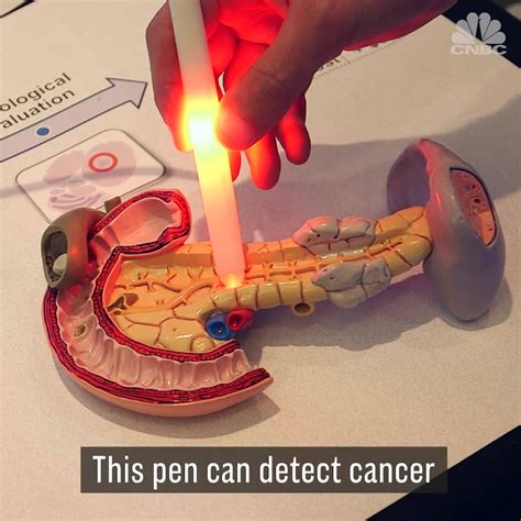 This Pen Can Detect Cancer In 10 Seconds During Surgery Lifeboat News