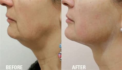 High Intensity Focused Ultrasound Hifu The Humming Bird Clinic