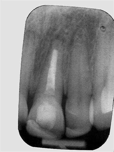 Cases Caendodonticsltd Dentures Save Your Tooth Root Canal