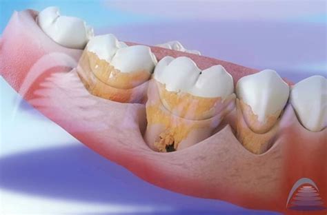 El sarro dental Por qué se forma y cómo se elimina Clínica Pardiñas