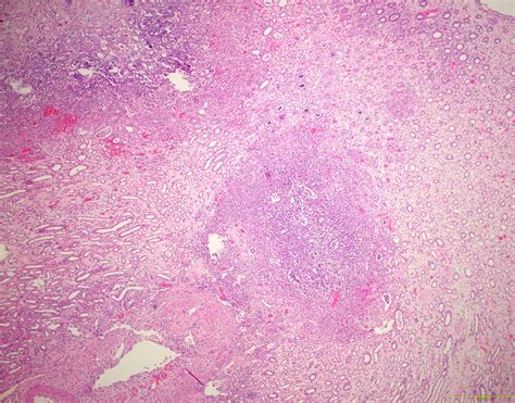 Pathology Outlines Acute Pyelonephritis