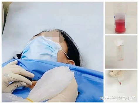 揭秘甲状腺结节的良恶性：甲状腺细针穿刺 知乎