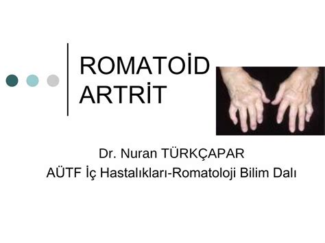 PDF ROMATOİD ARTRİT romatizmahastaliklari ROMATOİD ARTRİT Tüm