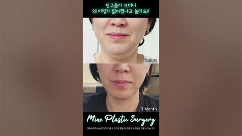 몇 년은 더 젊어진 기분이에요 미니목거상 이중턱 이중턱근육묶기 Shorts Youtube