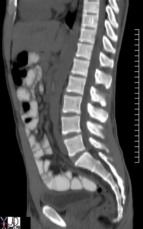 Sigmoid The Common Vein